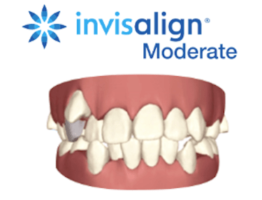 Invisalign Moderate: La revolución en ortodoncia para maloclusiones ...