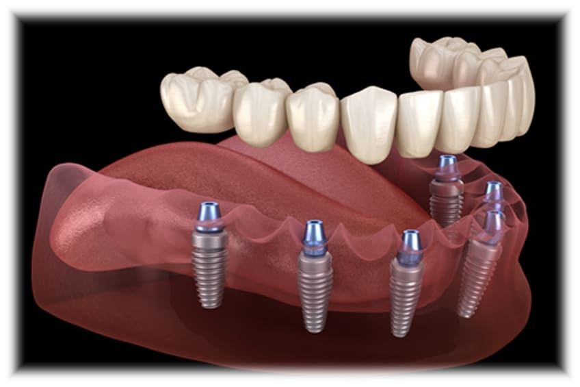 Prótesis dentales fijas y removibles: ¿Cuál es la mejor opción para tu ...