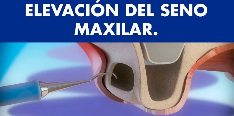 Elevación de seno maxilar: ¿En qué consiste?
